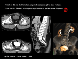 Exstrophie vésicale et épispade