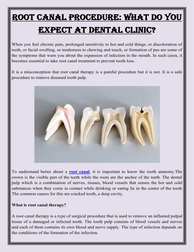 Root Canal Procedure What Do you Expect at Dental Clinic